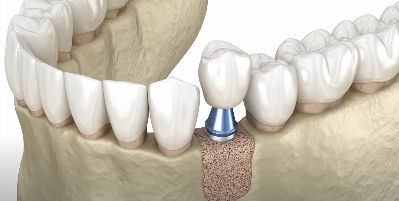 Best Choice for Full Mouth Dental Implant - New Teeth Now
