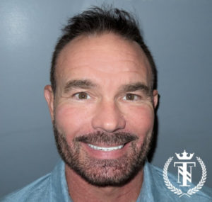Twenty-One, Transformed Smiles from 2021 - New Teeth Now