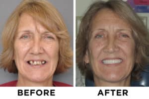 Our Dental Implant Patient Gallery | New Teeth Now Smiles