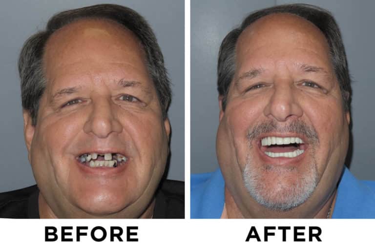 Our Dental Implant Patient Gallery | New Teeth Now Smiles