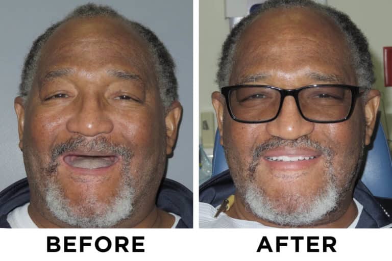 Our Dental Implant Patient Gallery | New Teeth Now Smiles