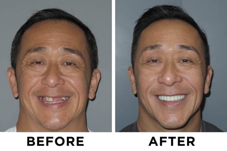 Our Dental Implant Patient Gallery | New Teeth Now Smiles