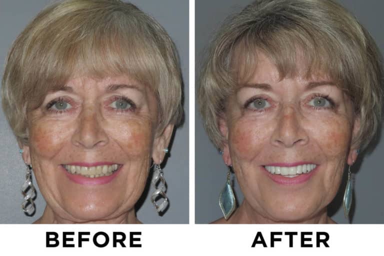 Our Dental Implant Patient Gallery | New Teeth Now Smiles