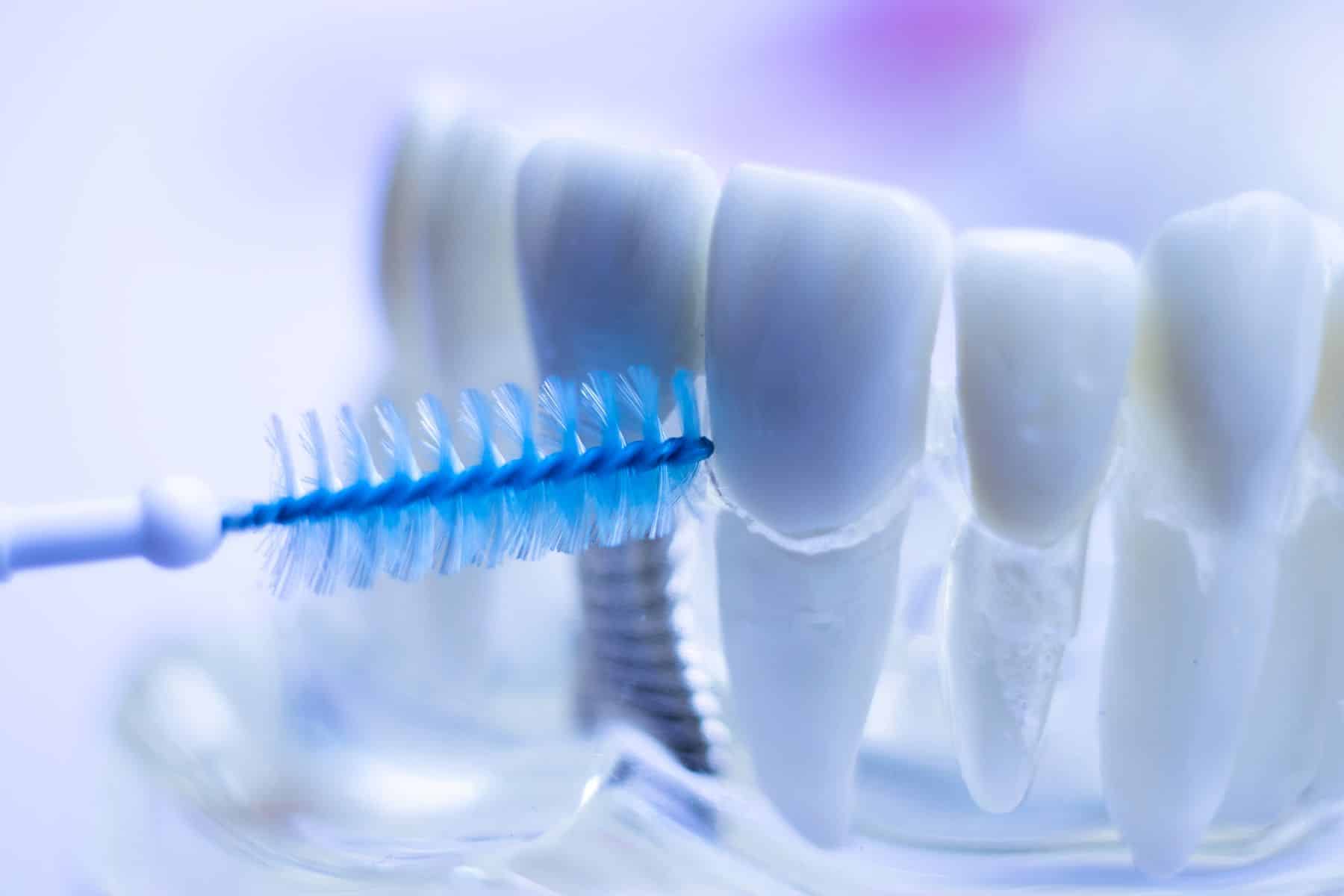 How to Clean Dental Implants - New Teeth Now