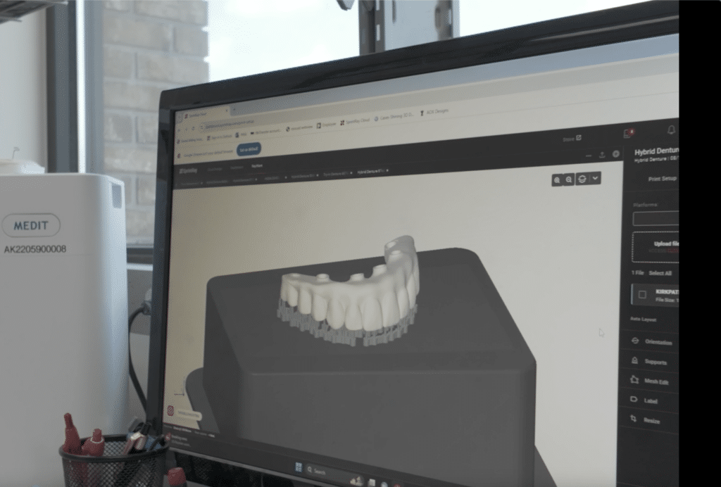 Digital Dentistry Transforms Implant Process | New Teeth Now