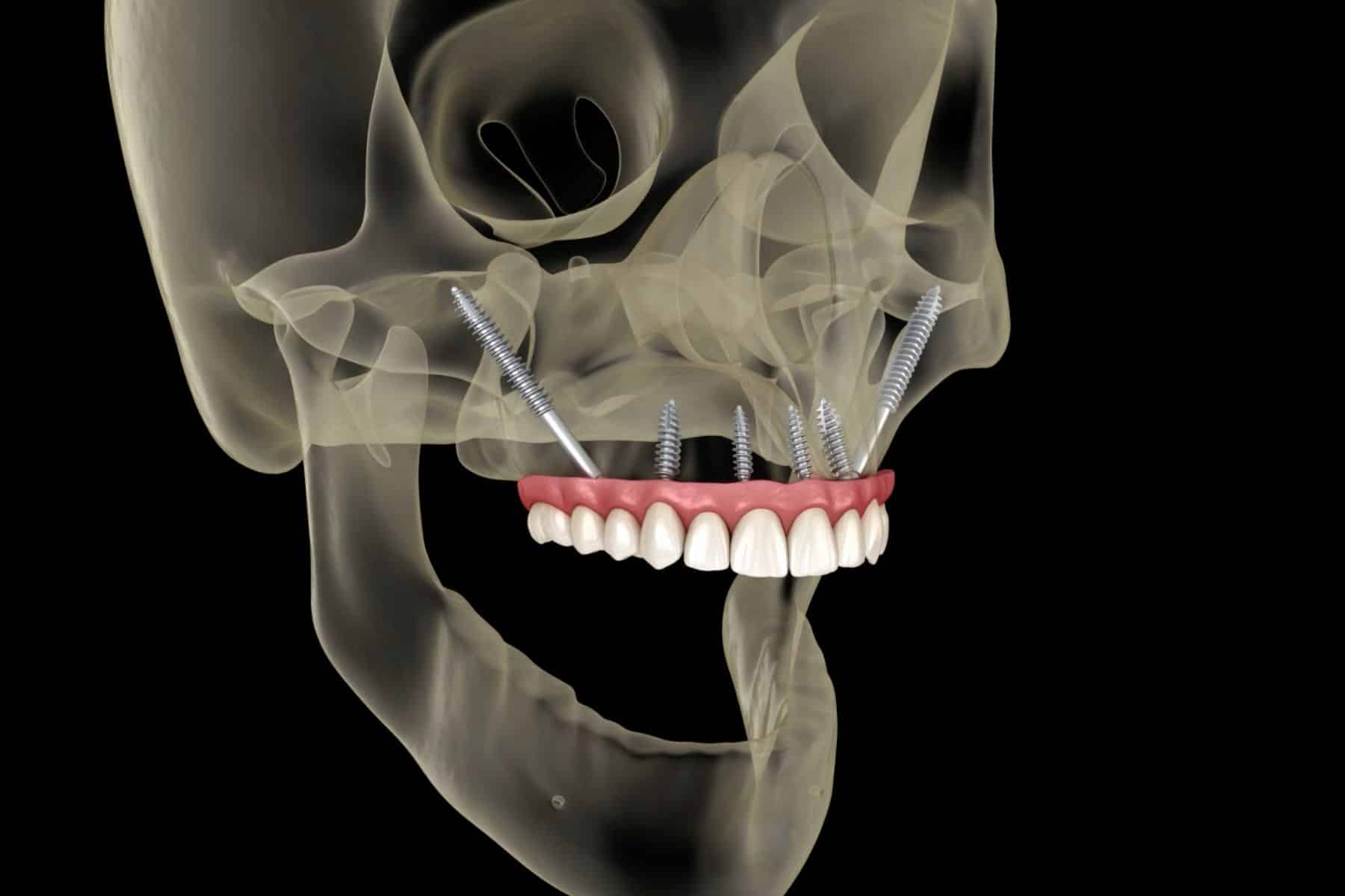 Best Choice for Zygomatic Implants - New Teeth Now
